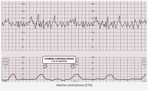 Cardiotocography Ctg Flashcards Quizlet