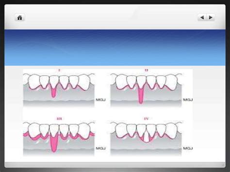 Root Coverage Procedures Pptx