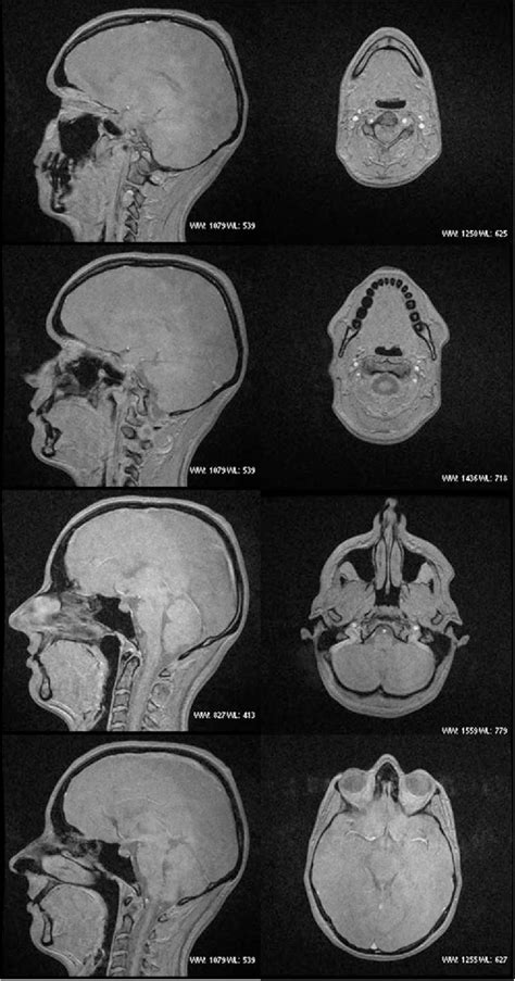 Figure 3 From Black Bone Mri A Partial Flip Angle Technique For Radiation Reduction In