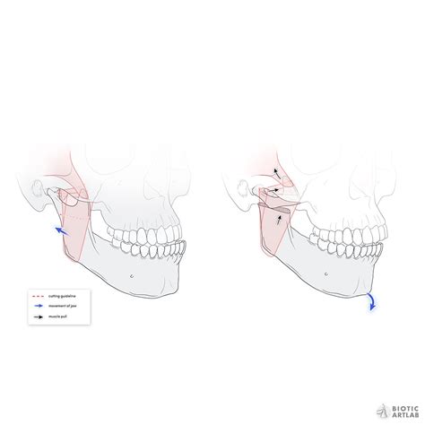 Maxillary Osteotomy Medical Illustrations — Biotic Artlab