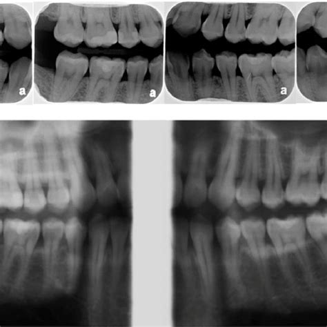 Intraoral And Panoramic Bitewing Radiographs Download Scientific Diagram