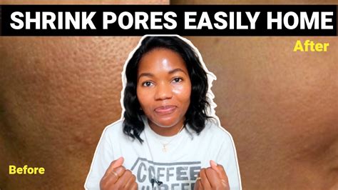 Proven Ways To Minimize Large Pores Naturally Say Goodbye To Pore Problems YouTube
