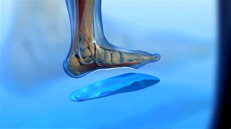 定制矫正鞋垫真的是智商税吗？ 知乎