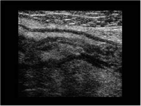 Abdomen And Retroperitoneum 1 5 Appendix Case 1 5 2 Uncomplicated