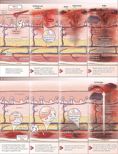 View Of Pediatric Necrotizing Fasciitis Journal Of The Pediatric Orthopaedic Society Of North
