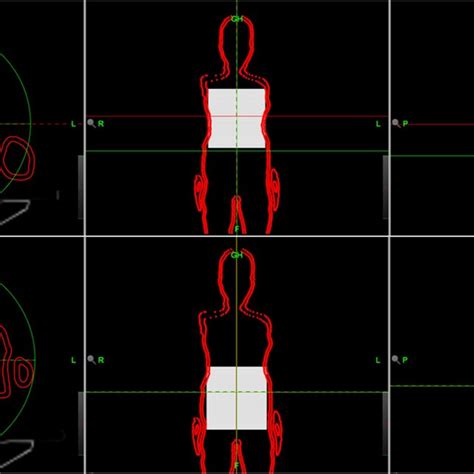 Dose Map Of Arccheck In The Thorax And Abdomen Regions Download