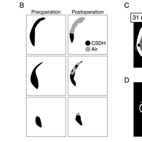 Nakaguchi Classification 16 Adapted From Nakaguchi H Tanishima T