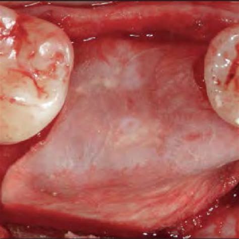 A Periapical Radiograph Showing Angular Bone Defects In 34 B Download Scientific Diagram