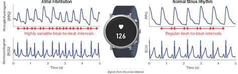 Atrial Fibrillation Detection Physiological Measurement IOPscience