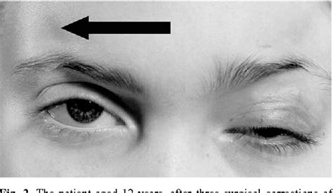 Figure 1 From Linear Scleroderma ‘en Coup De Sabre With Ptosis And