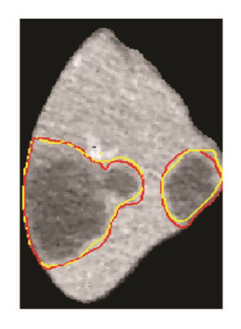 Comparisons Between Tumor Segmentation Results And Ground Truth Yellow