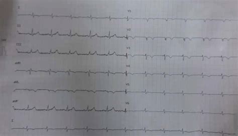 Ecg Shows Low Voltage Download Scientific Diagram