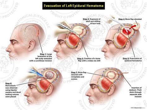Scalp Flap Surgery Before After Mapasgmaes