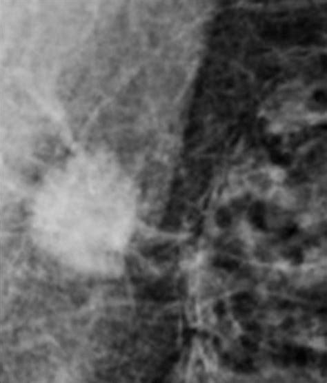 Breast And Axilla 52 Malignant Breast Lesions Case 522 Breast