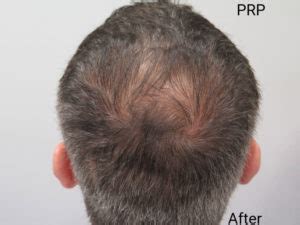 PRP Scalp Injections Before After Photos Laser Esthetica