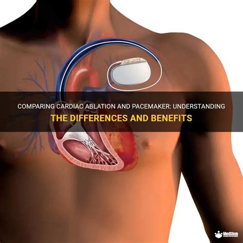 Comparing Cardiac Ablation And Pacemaker Understanding The Differences And Benefits Medshun