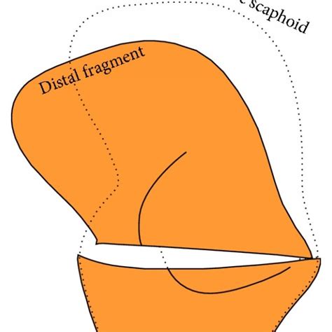 Scheme Of 3d Model Of Scaphoid Fragments Before Virtual Reduction A Download Scientific