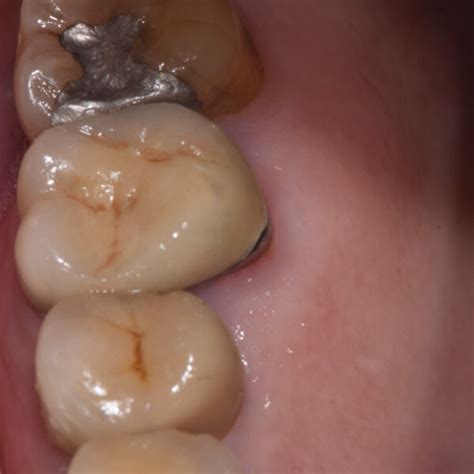 Palatal View Of The Right First Upper Molar Download Scientific Diagram