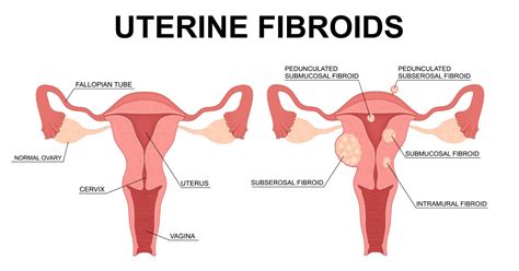Which Size Of Fibroid Is Normal American Fibroid Centers