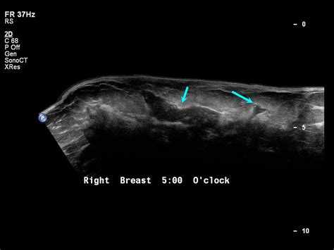 Atlas Of Breast Cancer Early Detection