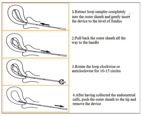 Endometrial Sampling Device Cpt Code At Mason Duckworth Blog Endometrial Sampling Device Cpt Code At Mason Duckworth Blog