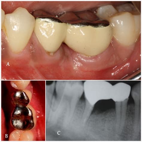 Root Resection For Future Implant Site Development The Transitional