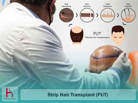 Best Hair Transplant Method Pros And Cons Of Popular Techniques Helia