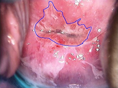 Colposcopy Digital Atlas