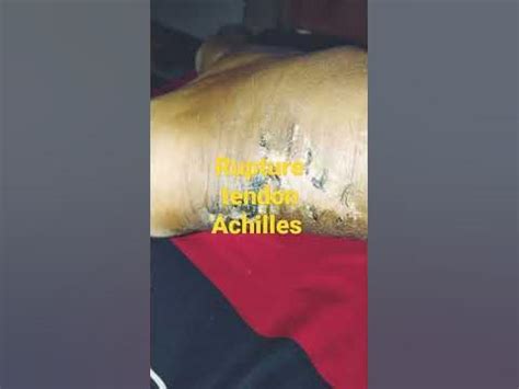 rupture tendon Achilles # operasi tendon Achilles #0_5 week(minggu ...