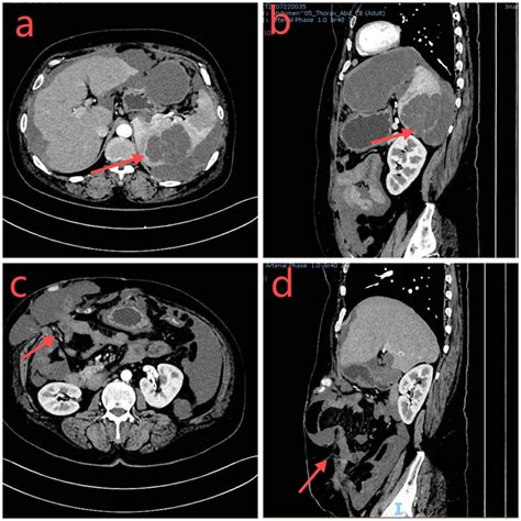 Frontiers Appendiceal Low Grade Pseudomyxoma Peritonei Recurrence