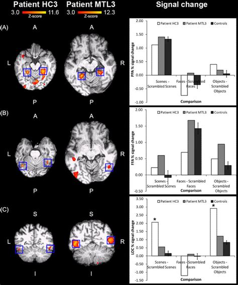 The A Ppa B Ffa And C Loc In Each Patient Blue Squares As Download Scientific Diagram