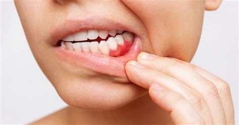 Gingivitis Causes Symptoms And Effective Treatments