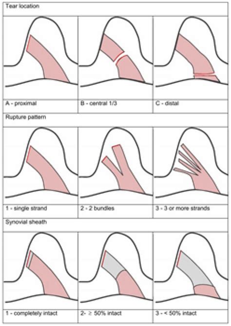 Schematic Overview Of The Classification Of Acl Ruptures Download