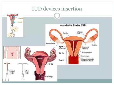 Insertion Of Iud Devicespptx