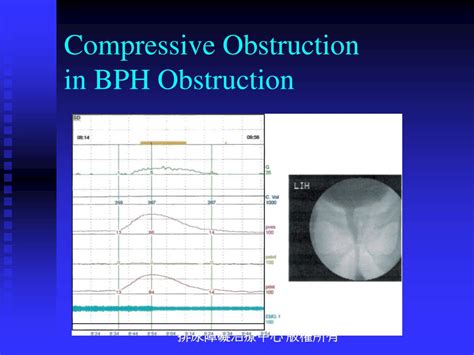 Ppt Urodynamics And Bladder Outlet Obstruction Powerpoint Presentation Id 1356300