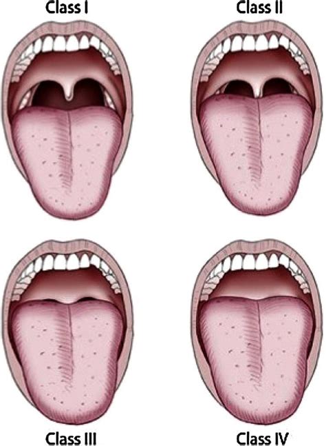 Mallampati Score To Help Predict Obstructive Sleep Apnea Updated 2026