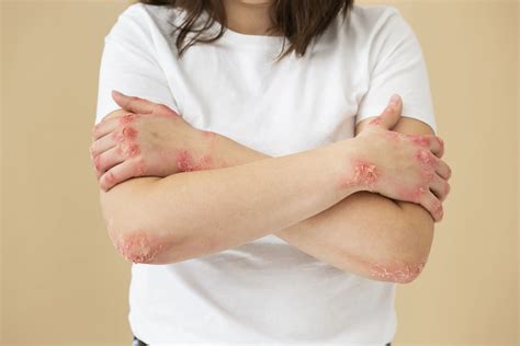Differentiating Hives And Rashes Identifying Key Distinctions
