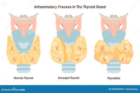 Thyroiditis Thyroid Inflammation Thyroid Gland Produces Abnormal