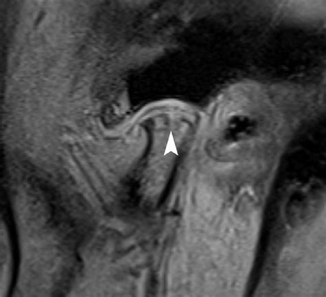 A Sagittaloblique T1 Weighted Image With Fat Saturation After