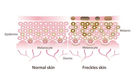 Cross Section Of Normal And Freckles Skin Layer Vector Illustration