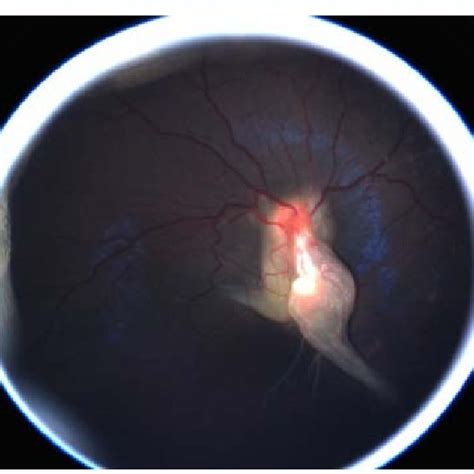 Vascular Ectatic Alterations With Vascularized Stalk Right Eye Seen Download Scientific