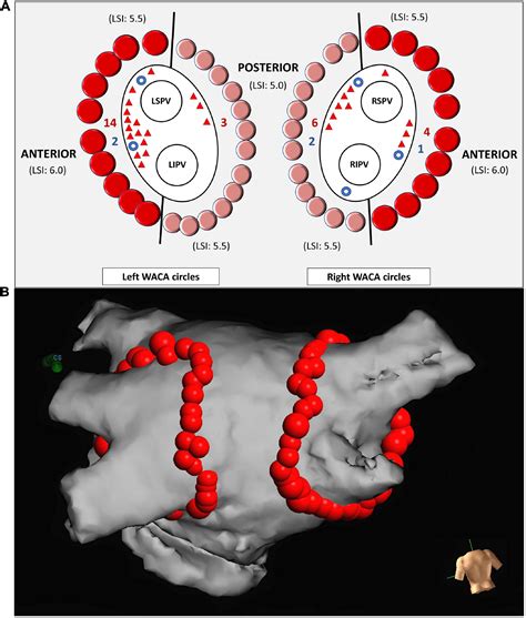 Frontiers Risk Factors For Late Reconnections After Circumferential Pulmonary Vein Isolation
