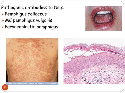 Desmosomes Pptx Skin And Dermatology Diseases And Conditions