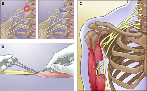 A An In Continuity Neuroma Of The Upper Trunk Of The Brachial Plexus Is