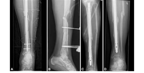 A D A This Radiograph Shows A 5 Day Postoperative Grade I Open Download Scientific Diagram