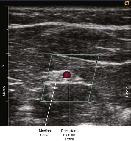 Median Nerve Block Radiology Key