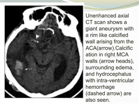 Physiological And Pathological Calcification Of Brain Pptx