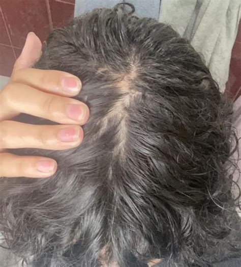 Am I Balding Whats Wrong With My Scalp Rcurlyhair