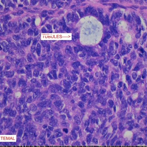 Microscopic Features Of Adult Wilms Tumour Showing Blastemal Elements