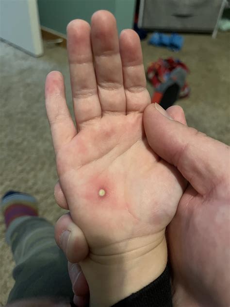 Does This Look Like A Wart Or Bug Bite Or What On 4 Yo Son R Warts